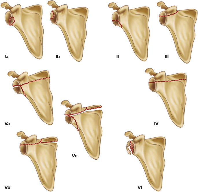 Classification Systems for Scapular Fractures: How Useful Are They ...