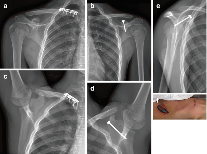 Scapular Fractures in Children and Adolescents | Springer Nature Link ...