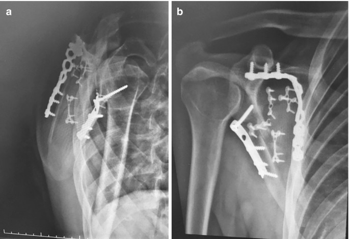 Special Considerations: Fractures of the Scapular Neck and Body ...