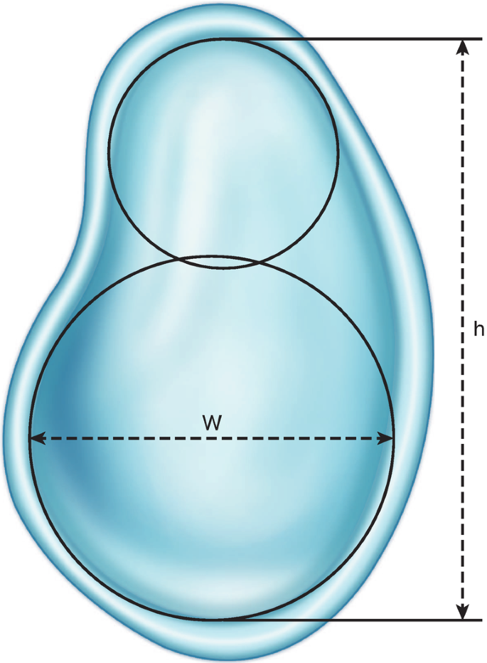 Special Considerations: Articular Involvement (Glenoid Fossa and Rim ...