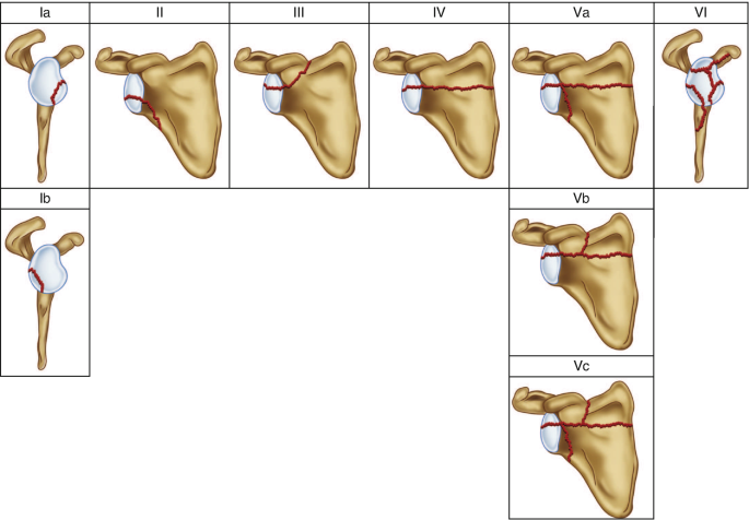 Special Considerations: Articular Involvement (Glenoid Fossa and Rim ...