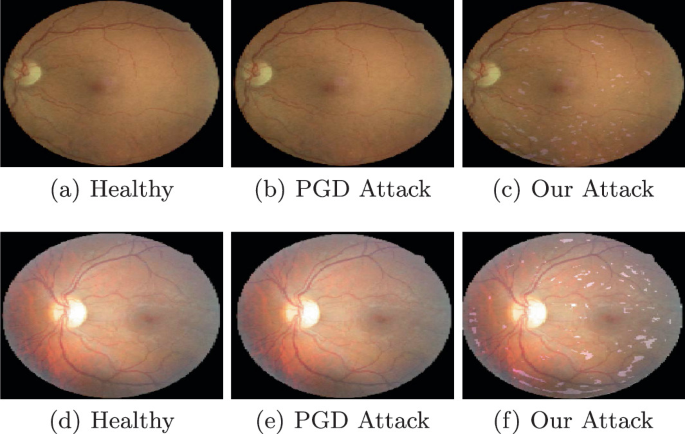 Making Domain Specific Adversarial Attacks for Retinal Fundus Images ...