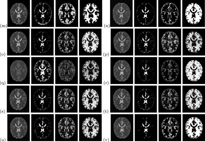 Rough Spatial Ensemble Kernelized Fuzzy C Means Clustering for Robust Brain MR Image Tissue ...