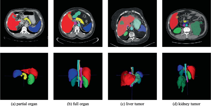 AdaptNet: Adaptive Learning from Partially Labeled Data for Abdomen Multi-organ and Tumor ...