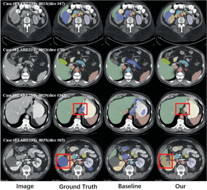 Two-Stage Training for Abdominal Pan-Cancer Segmentation in Weak Label ...