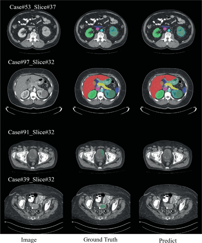 Exploiting Pseudo-labeling and nnU-Netv2 Inference Acceleration for Abdominal Multi-organ and ...