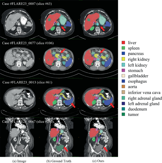 Multi-Organ and Pan-Cancer Segmentation Framework from Partially Labeled Abdominal CT Datasets ...