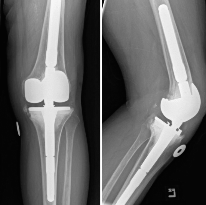 Management of Reinfection After One-Stage Exchange Arthroplasty ...