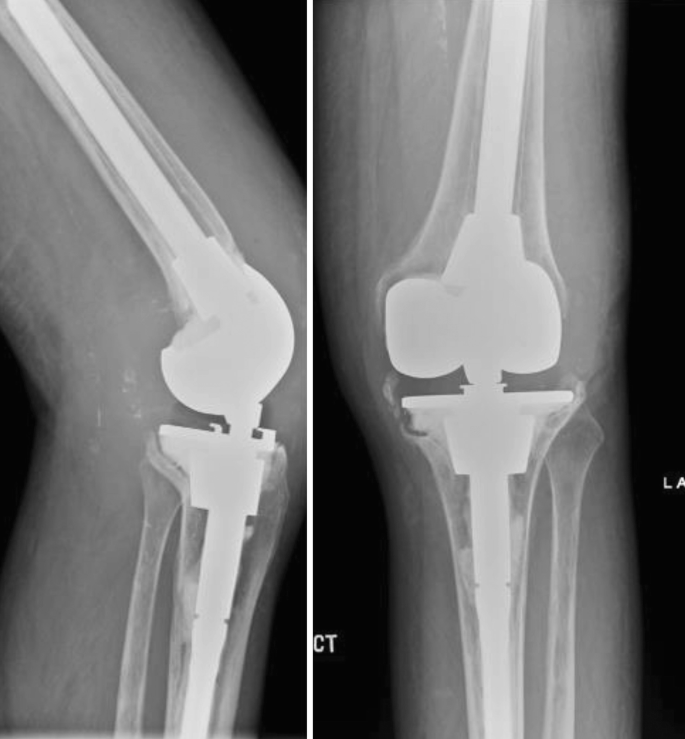 Management of Reinfection After One-Stage Exchange Arthroplasty ...