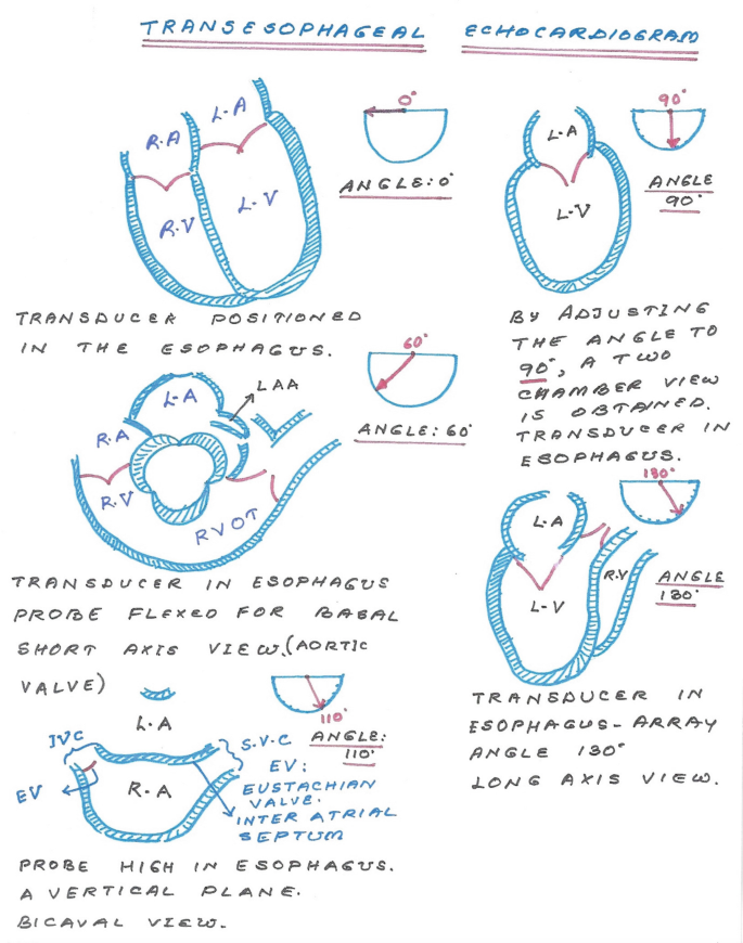 Transesophageal Echocardiogram (TEE), Harmonics and Contrast ...