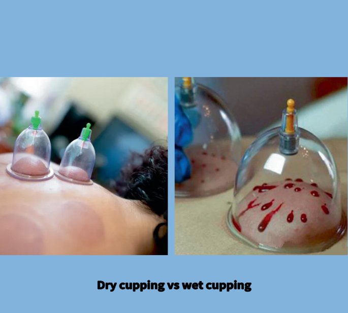 Cupping Therapy | SpringerLink