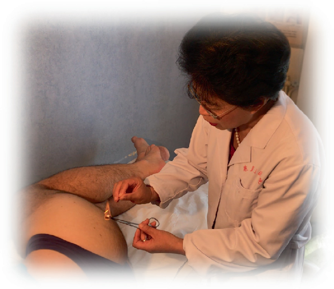 Fire Needling | SpringerLink