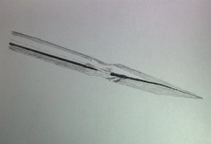 Three-Edged Needle, Plum-Blossom Needle and Gua Sha | SpringerLink