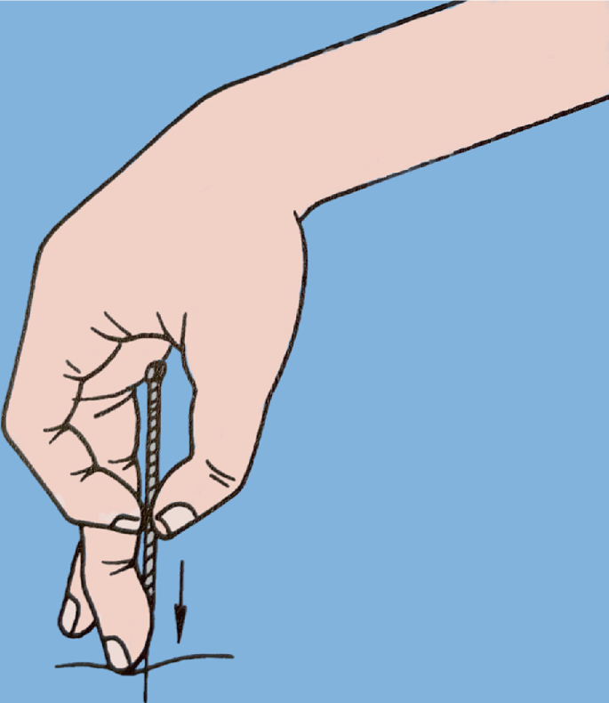 Basic Needling | Springer Nature Link (formerly SpringerLink)