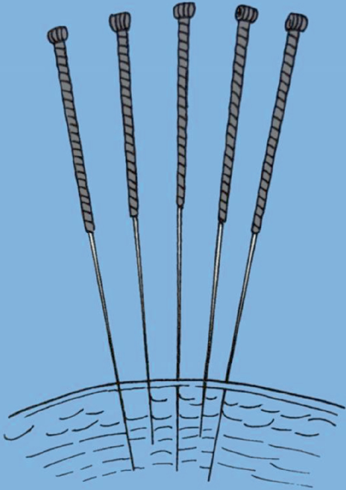 Classical Needling: Huang Di Nei Jing and Nanjing | SpringerLink