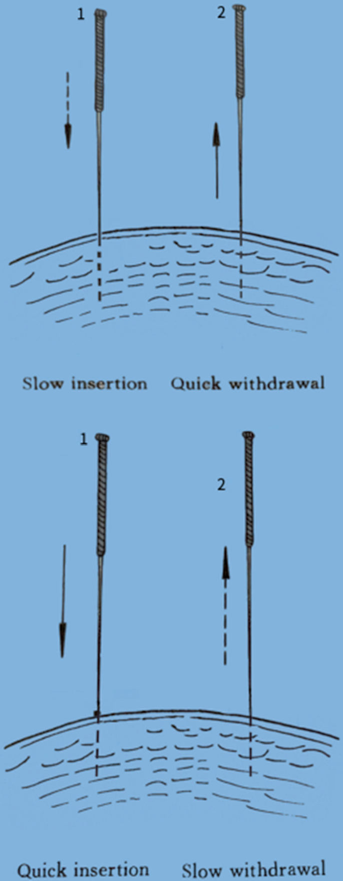 Jinzhenfu Needling Methods and Needling Technique on Reinforcement and ...