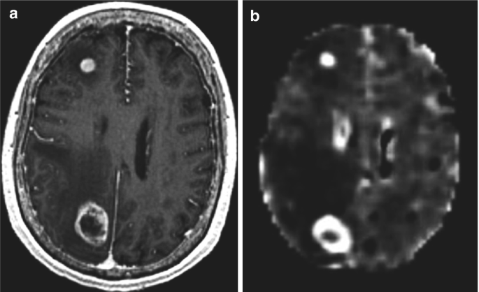 Conventional and Advanced MRI in Neuro-Oncology | Springer Nature Link