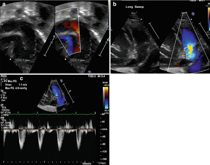 Atrioventricular Valves and Atrioventricular Connections | SpringerLink