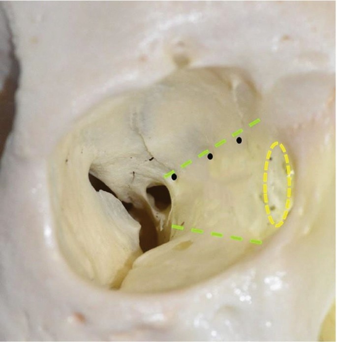 Transorbital Neuroendoscopic Surgery | SpringerLink