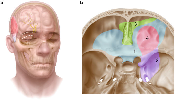 Supraorbital Versus Transorbital Keyhole Approaches: Selecting the ...