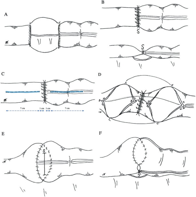 Anastomotic Techniques for Crohn’s Surgery | SpringerLink
