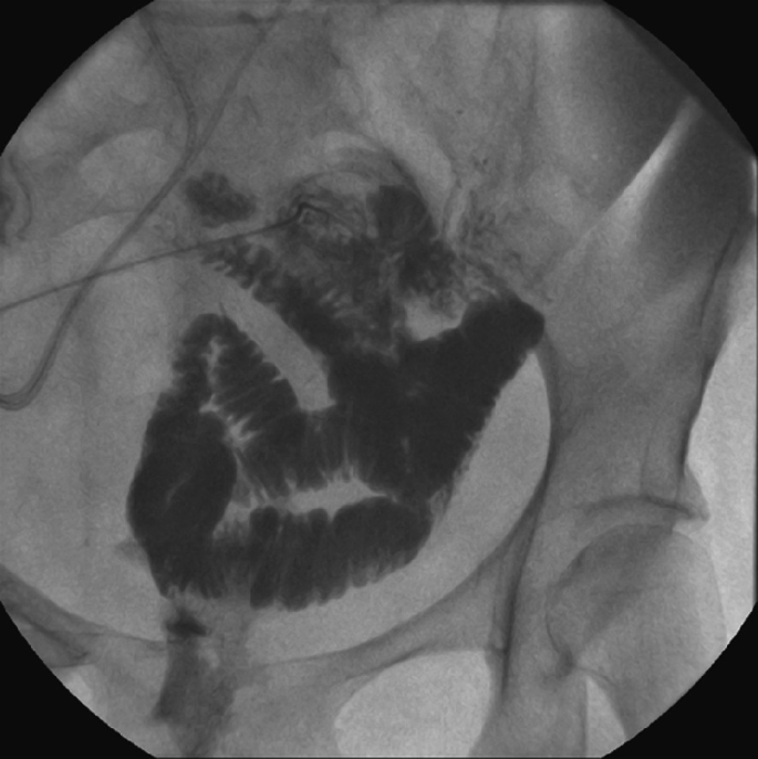 Empty Pelvis Syndrome Complication Management Following Pelvic ...