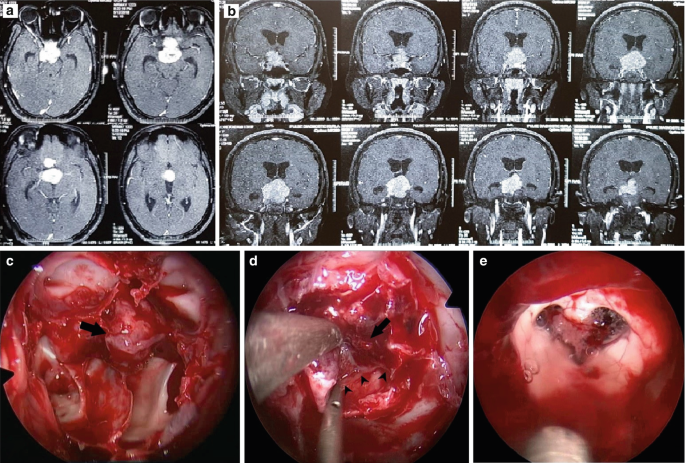 Endonasal Endoscopic Skull Base Surgery in Children: Anatomical and ...