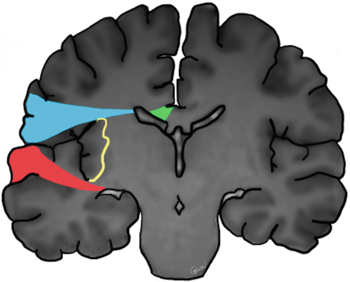 Functional Hemispherotomy and Variants for Treatment of Epilepsy ...