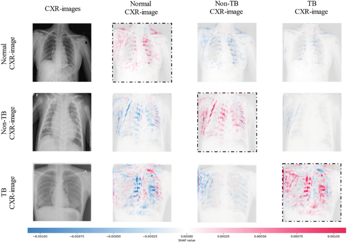 Interpretable Deep Learning Model for Tuberculosis Detection Using X ...