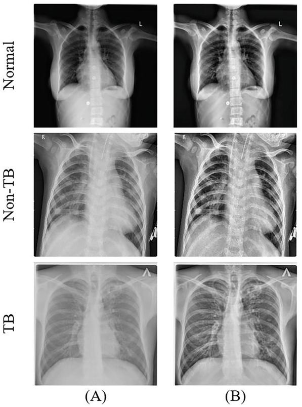 Interpretable Deep Learning Model for Tuberculosis Detection Using X ...