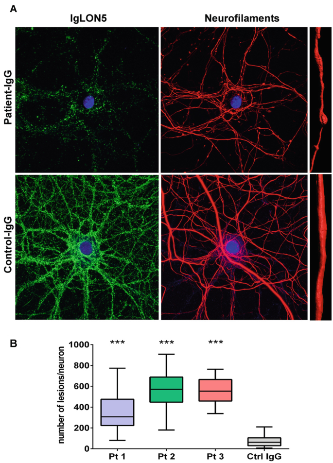Anti-IgLON5 Disease: A Cross Talk between Autoimmunity and Tauopathy ...