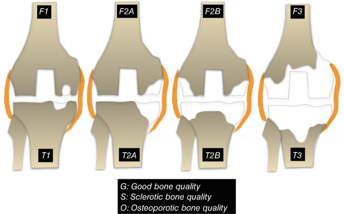 Metal Augments, Polyethylene Thickness, and Stem Length Affect Tibial ...