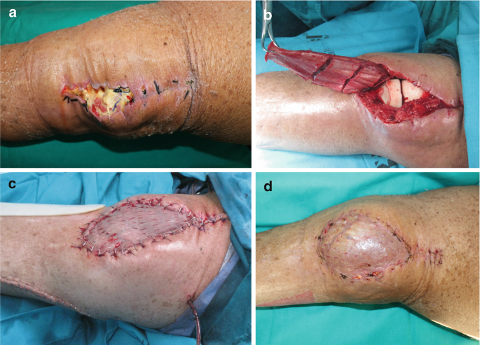 Wound Complications Following Revision Total Knee Arthroplasty ...