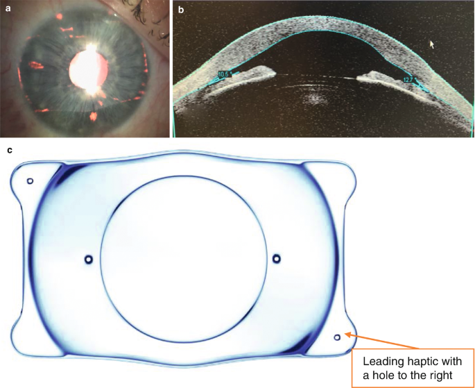 Phakic Intraocular Lens Implants | SpringerLink