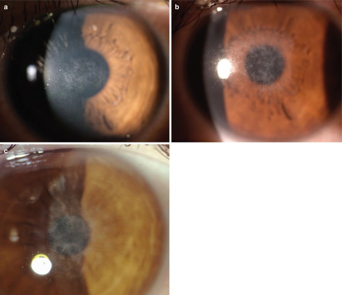Corneal Haze | SpringerLink