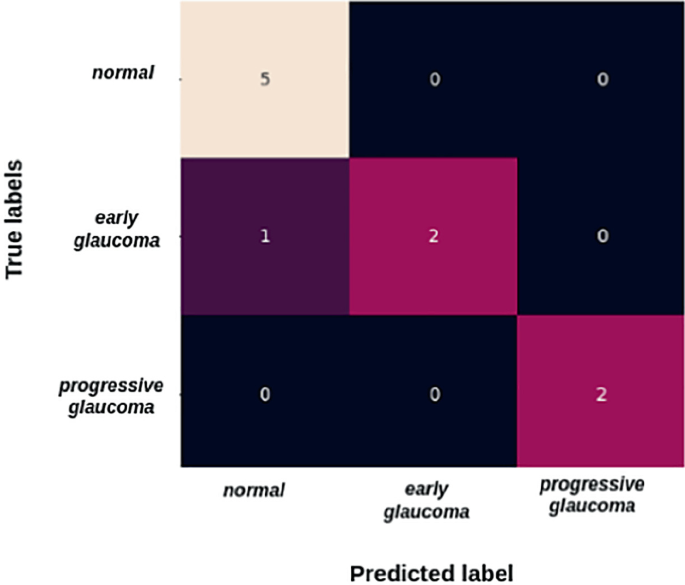 Glaucoma Grading Using Fundus Images | SpringerLink