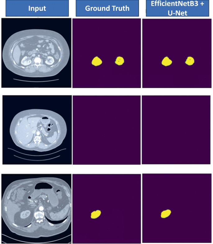 Evaluation of Transfer Learning with a U-Net Architectures for Kidney Segmentation | SpringerLink