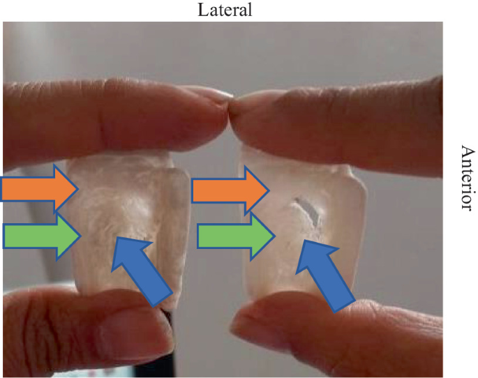 Experimental Dynamic Testing for Wear of TMJ Prosthesis Component in a ...