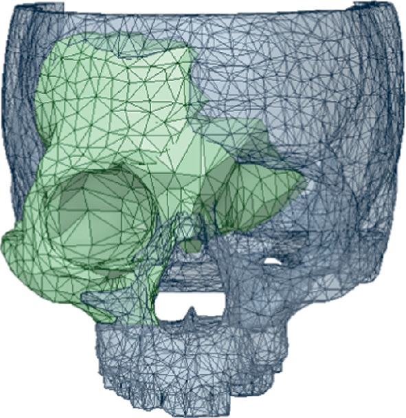 Generative Design Prosthesis Proposal for the Case of a Bullet Impact ...