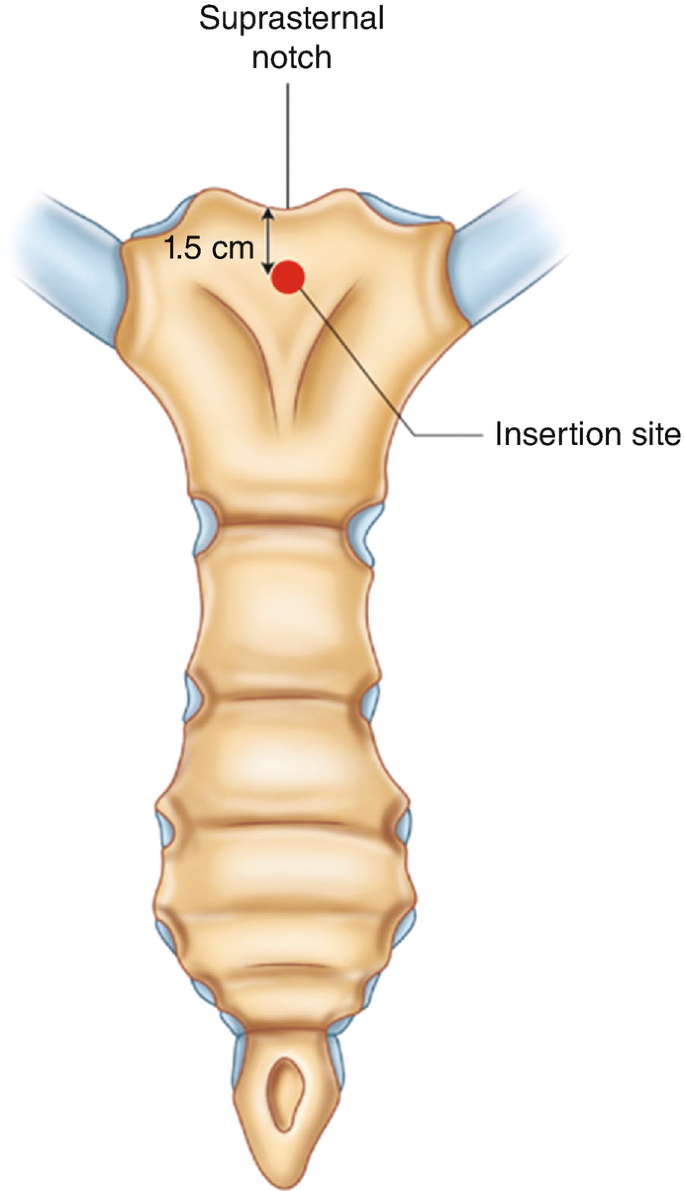 Intraosseous Access Site Selection | SpringerLink