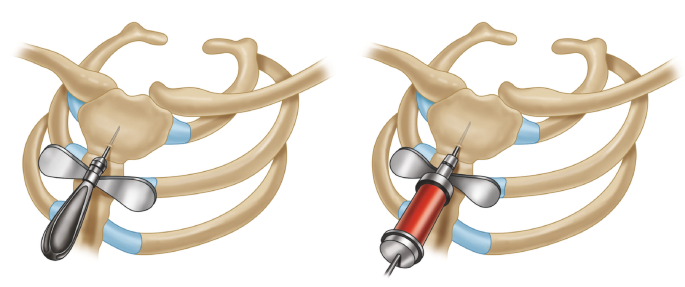 Manual Intraosseous Devices | SpringerLink