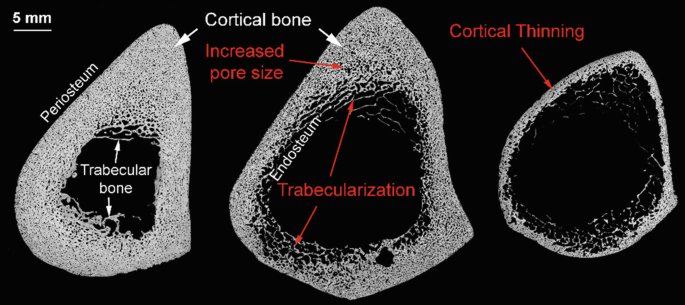 Quantitative Bone Ultrasound | SpringerLink