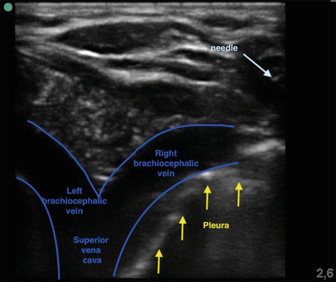 Right Brachiocephalic Vein in Pediatrics | SpringerLink