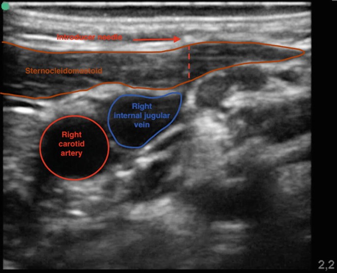 Right Internal Jugular Vein in Pediatrics | SpringerLink