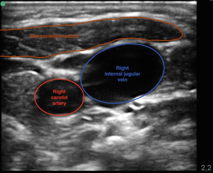 Right Internal Jugular Vein in Pediatrics | SpringerLink