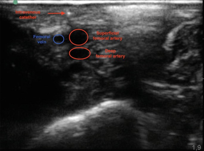 Left Femoral Vein in Pediatrics | Springer Nature Link