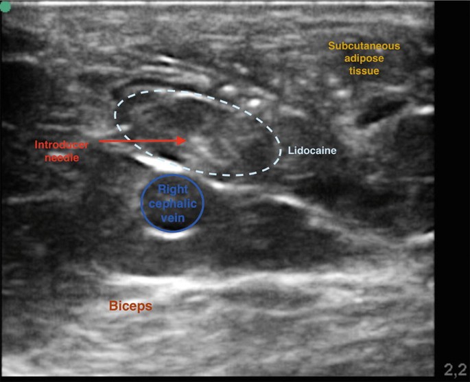 Cephalic Vein in Pediatrics | Springer Nature Link