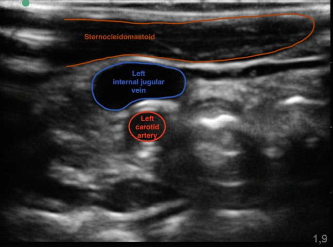 Left Internal Jugular Vein in Pediatrics | SpringerLink