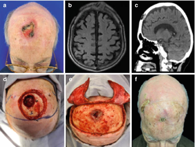 Fundamentals of Squamous Cell Carcinoma | SpringerLink