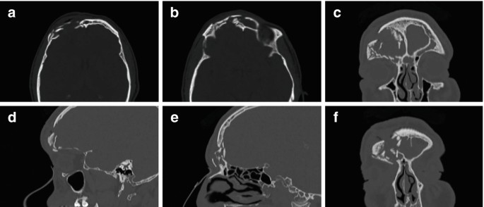 Fundamentals of Frontal Sinus Fractures | Springer Nature Link